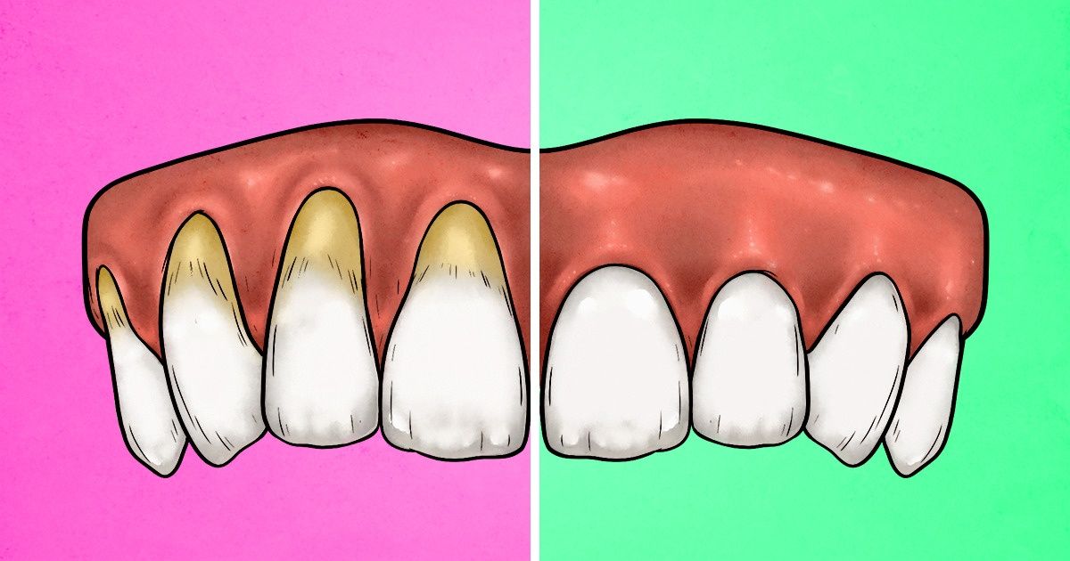 4 Signs You’re Brushing Your Teeth Too Hard, and 4 Ways You Can Fix It